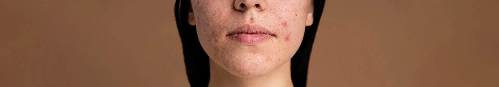 Boutons autour de la bouche : causes et solutions | Garnier