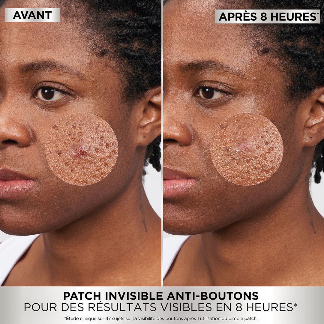Patch boutons Pure Active : soin actif anti-imperfections | Garnier