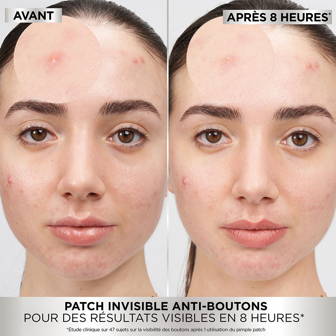 Patch boutons Pure Active : soin actif anti-imperfections | Garnier